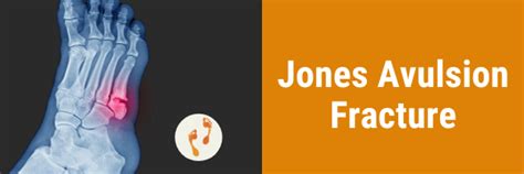 Styloid Process Foot