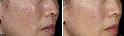 Pico Enlighten San Jose CA Jenesis Lipoplasty