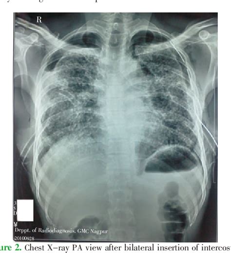 Figure 1 From Miliary Tuberculosis With Bilateral Pneumothorax A Case
