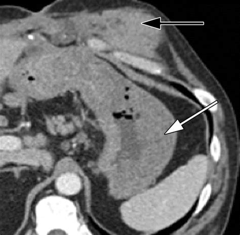 Imaging Of Abdominal Wall Masses Masslike Lesions And Diffuse