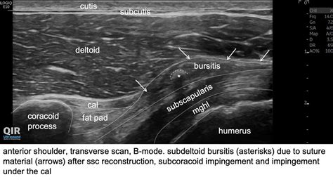 Subcoracoid Bursitis