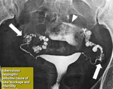 Dr Huma Sheikh On Linkedin Emerging Cases Of Pelvic Tuberculosis Tb
