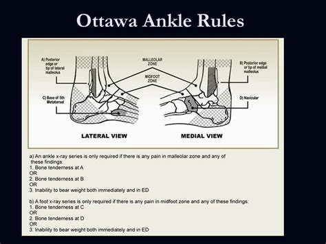 Ottawa Ankle Rules At Sharon Soliz Blog
