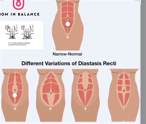 Mindful Mama Method Diastasis Recti Can Come In Various Forms As