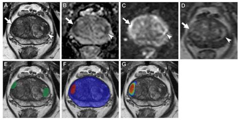 Mri Based Deep Learning Algorithm Shows Comparable Detection Of Cspca To Radiologists