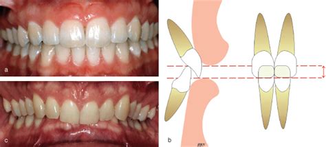 23 Deep Overbite Malocclusion Pocket Dentistry