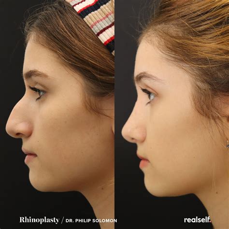 Rhinoplasty Glasgow Nose Job Nose Surgery Scotland Artofit