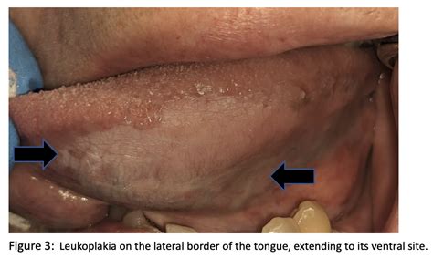 White Oral Lesions That Need Your Attention