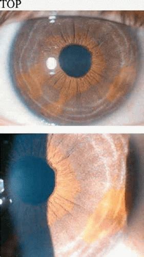 Pathology Of Iris Atrophy Ento Key