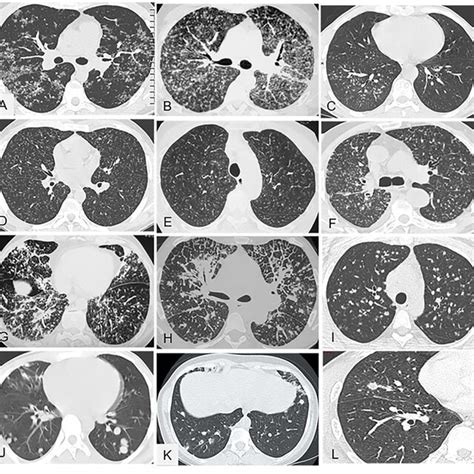 Representative Of Micronodular Parenchymal Pattern A H And Nodular