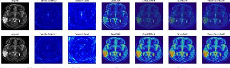 Figure 12 From Explainable Cost Sensitive Deep Neural Networks For Brain Tumor Detection From