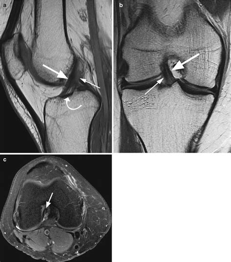 Anterior Cruciate Ligament Mri