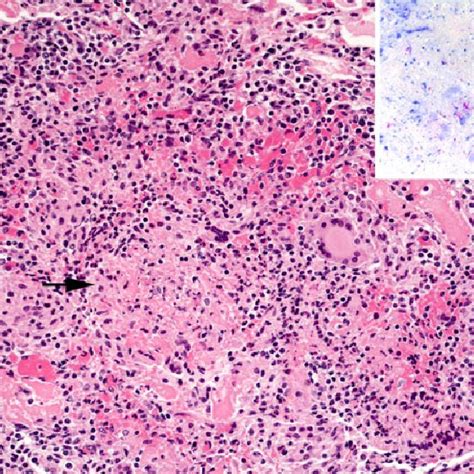 Mycobacterium Bovis Infection Lung Bovine 15 Days Postchallenge In