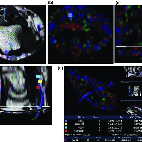 Distribution Of DTI Values In Both Groups In Our Study Download Scientific Diagram
