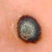 Laser Wart Removal Solihull Medical Cosmetic Clinic