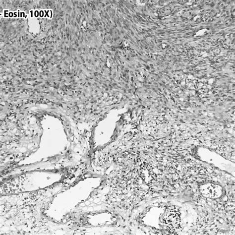 Cellular Spindle Cell Tumor With Branching Thick Blood Vessels