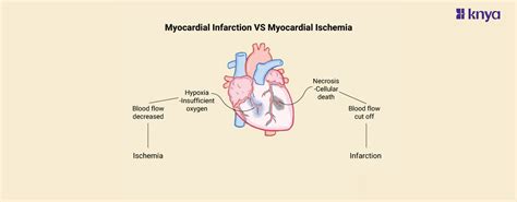 Myocardial Infarction Vs Myocardial Ischemia Key Differences Knya