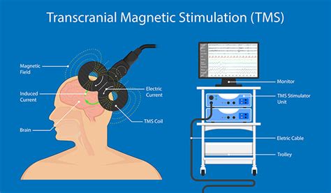 Accelerated Tms Therapy A Comprehensive Guide Brain Health Center