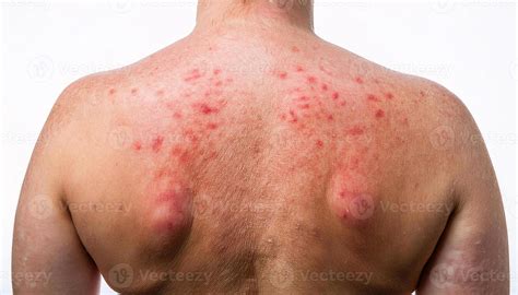 Close Up Of Severe Heat Rash On The Back With Inflamed Red Bumps And