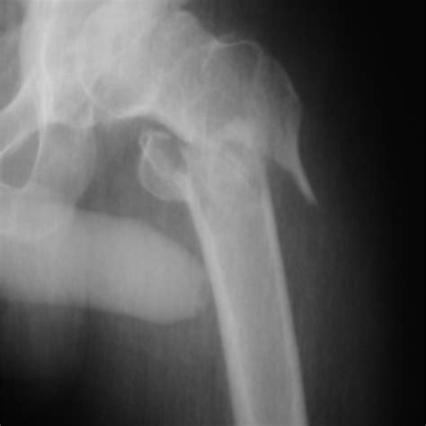 Pdf Avaliação Da Reprodutibilidade Da Classificação De Tronzo Para Fraturas Intertrocantéricas