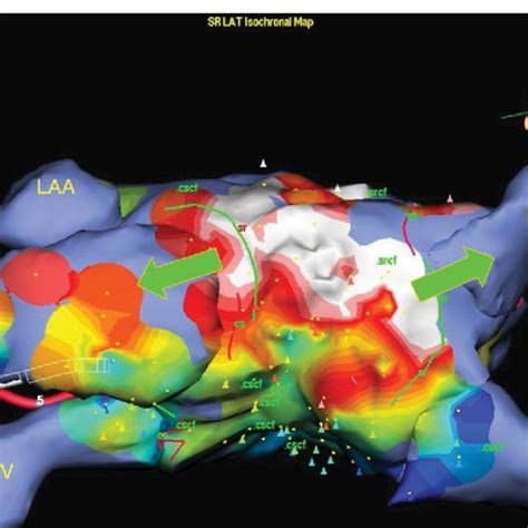 Wavefront Propagation Into Pulmonary Vein Antra Wavefront Propagation Wavefront Propagation Into Pulmonary Vein Antra Wavefront Propagation