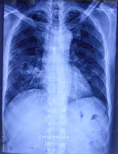 Cxr X Ray Of Chest Pa View Pulmonary Tuberculosis With Pneumonia Non Homogeneous Opacities