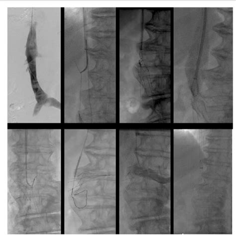 This Patient Had An Argon Option Elite Filter Argon Medical Devices
