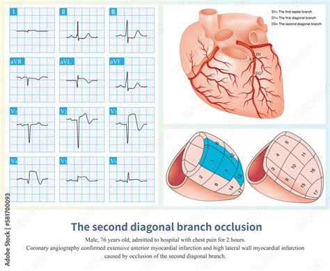 when the second diagonal branch of the lad is occluded it causes a