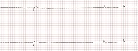 Hjärtstopp Fall 8 Klinisk diagnostik