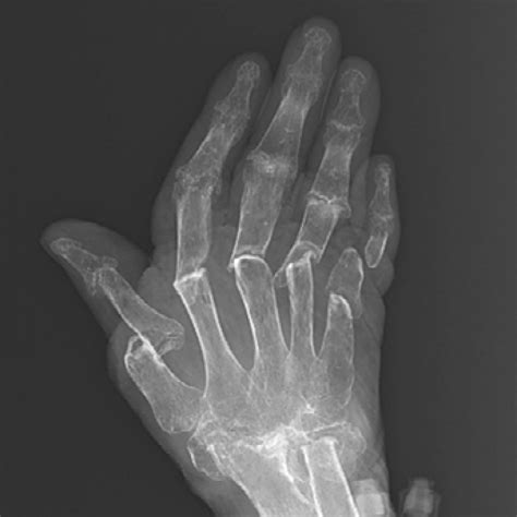 Dr Omid Bandarchi M D On Twitter 🔴comment 3 For Tweet Of Msk Presentations Ra A Lady Age 69