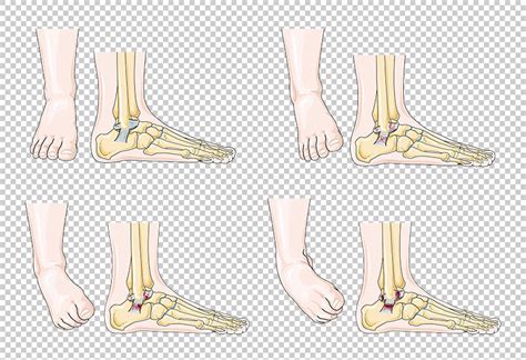 Esguince De Tobillo Vector Ilustración Científica