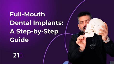 Full Mouth Dental Implants Step By Step Guide Procedure At 21d Youtube
