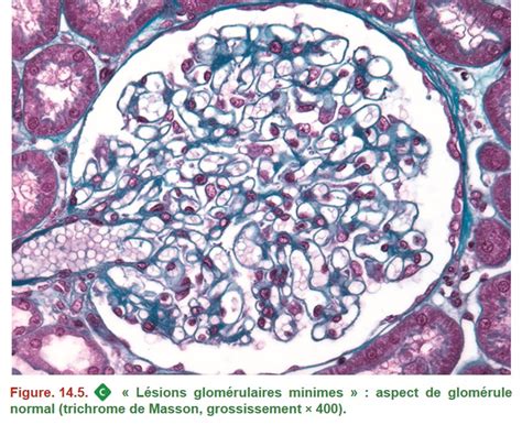 Société Française De Pathologie V Néphrologie