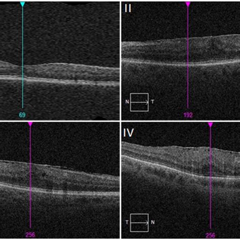 Stages Of Erm Showed On Optical Coherence Tomography Oct Images I