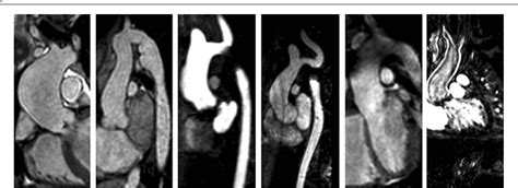 Figure 1 From Patient Specific Three Dimensional Aortic Arch Modeling