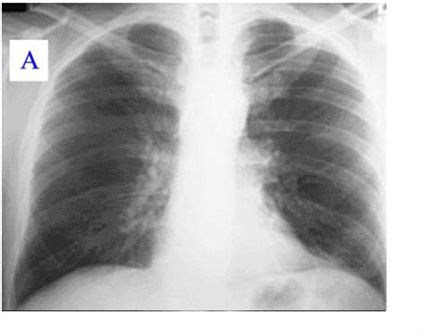 Chest X Ray Based Pneumonia Classification Towards Ai