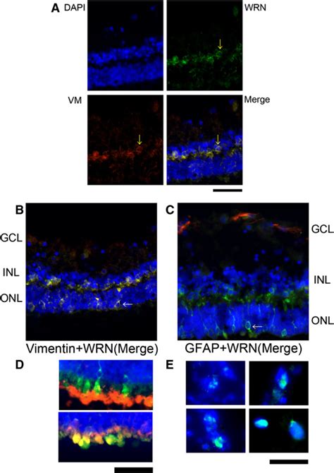 Expression And Localization Of Wrn Proteins In Human Retinas Wrn
