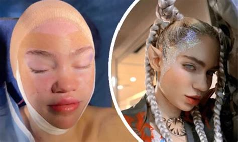 Grimes Shares A Snap Of Her Bandaged Face After Revealing She Wants To Get Elf Ear Surgery