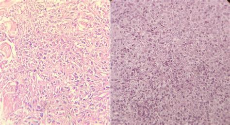 Histopathology Reveals Diffuse Sheets Of Large Noncleaved Atypical