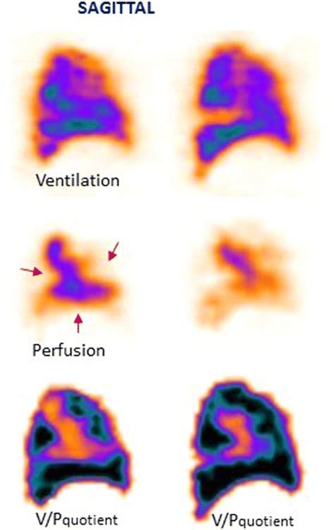 Patient With Chronic Pe The Perfusion Is Only Maintained In The Download Scientific Diagram