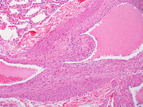 Completely Organized Thromboembolus Producing Intimal Fibr… Flickr