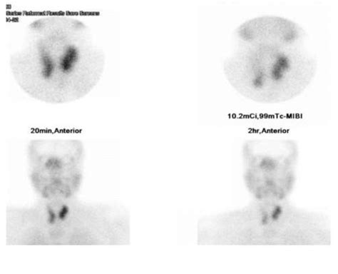 Sestamibi Scan Showing Parathyroid Hyperplasia Download Scientific Diagram