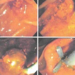 Second ERCP Source Medical Records Download Scientific Diagram