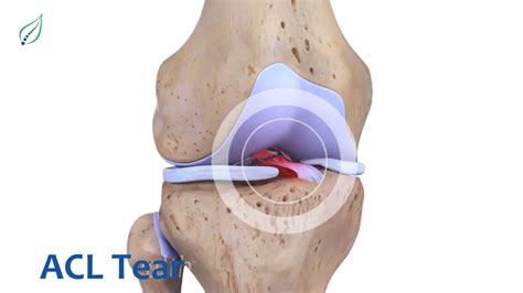 Non Surgical Treatment Of Acl Tear Spinalogy Clinic Best Back Pain