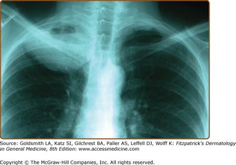 Pyoderma Gangrenosum Plastic Surgery Key