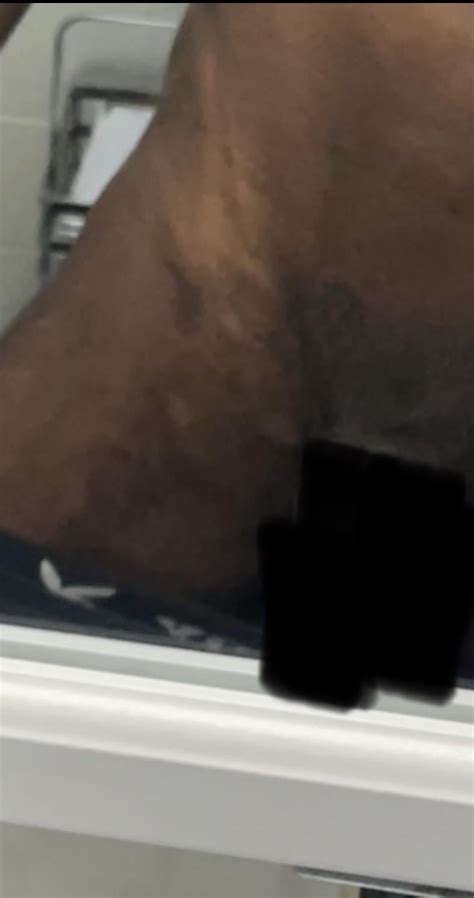 I Have These Lymph Nodes Around My Groin Area Should I Be Concerned