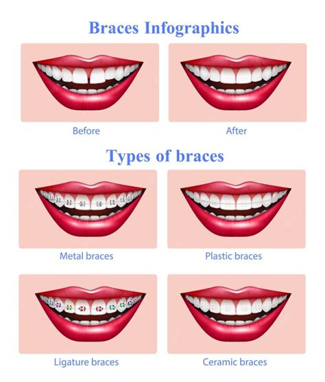 Difference Between Brackets And Braces Teeth At Shaun Dorsey Blog