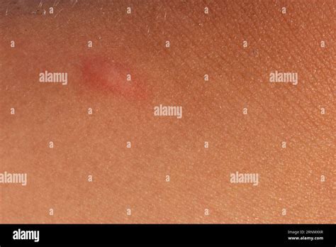 Insect Bite Close Up On The Skin Allergic Reaction Diseases And Treatment Of Skin Diseases
