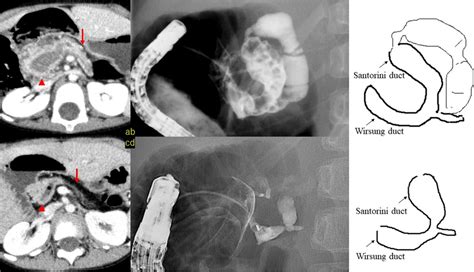 Case 1 Computed Tomography Ct And Endoscopic Retrograde
