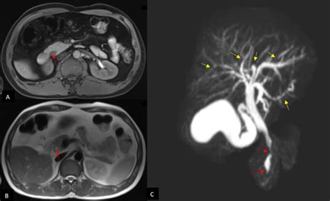 Axial T1 Noncontrast A And T2 B Weighted Mri Images Showing A Download Scientific Diagram